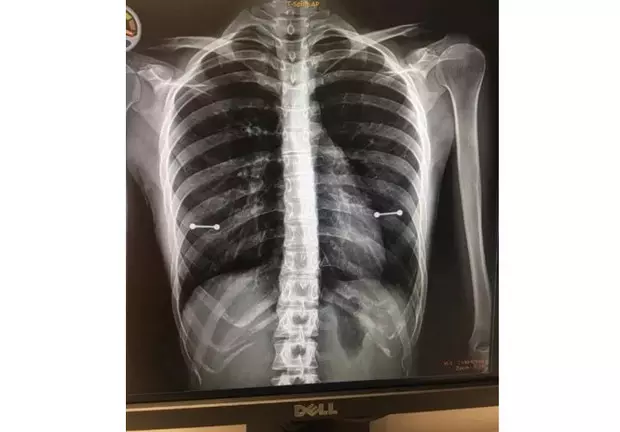 Foto número 3 - A garota fez um piercing de mamilos em segredo da mãe, mas seu X-Ray emitido emitido