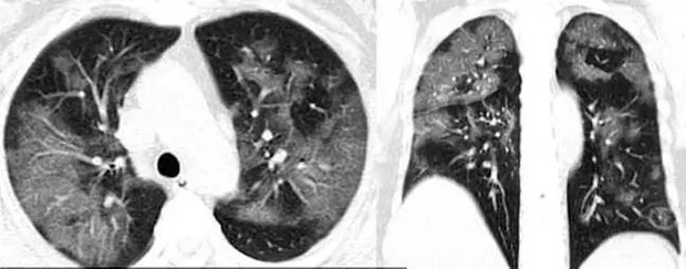 Photo №2 - was die Lungen von Coronavirus betroffen sind, sehen aus wie ein Röntgenstrahl