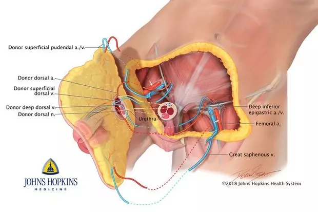 Foto №2 - Dokter mentransplantasikan penis, dan dia bekerja